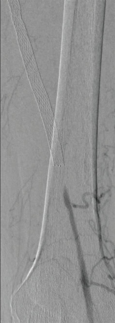 Percutaneous Transmural Arterial Bypass Ptab A Novel Addition To The Treatment Options For