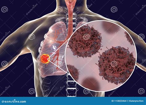 Рак легких, иллюстрация иллюстрация штока. иллюстрации насчитывающей ...