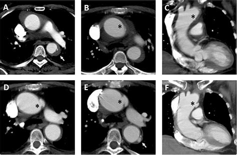 Frontiers Ct Characteristics And Clinical Implications Of Acute Type