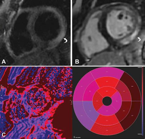 Cardiac Mri State Of The Art Radiology
