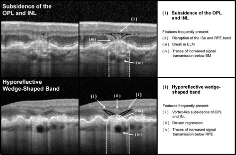 Geographic Atrophy Oct