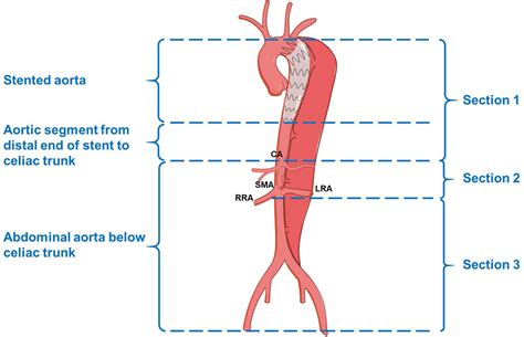 Abdominal Aorta Celiac Trunk