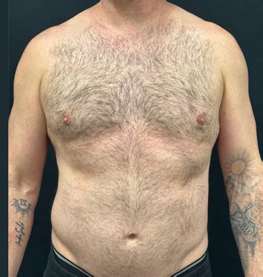 Before And After Photos Gynecomastia