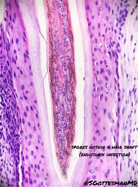 Tinea Capitis Ectothrix