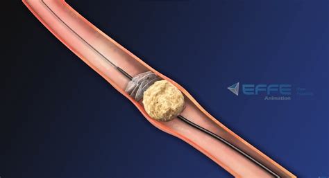 Urologic Surgery Animation Company 3d Urology Visuals