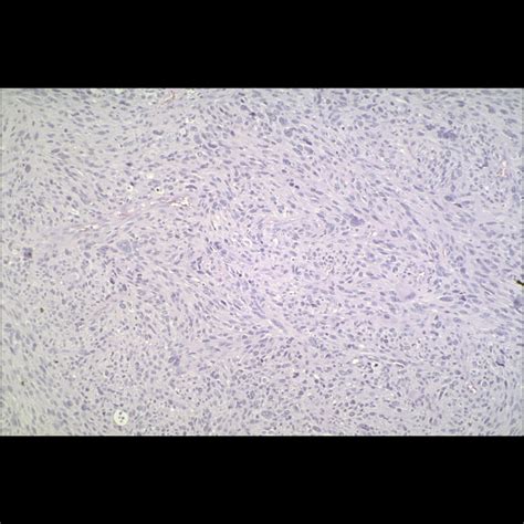 Plexiform Neurofibroma Histopathology
