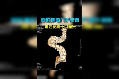 病房里让人羡慕的爱情故事：挺直腰杆，我就嫁给你！脊柱侧弯腰杆病房