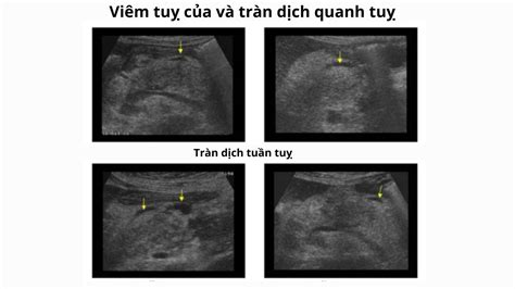 Siêu âm Tuỵ Vai Trò Trong Chẩn đoán Và Quy Trình Thực Hiện