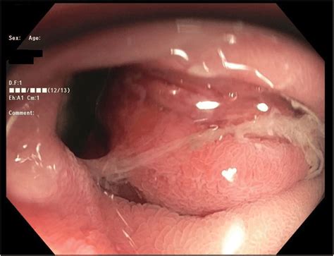 Egd Of The Duodenum Reveals A Congested Mucosa With Luminal Narrowing