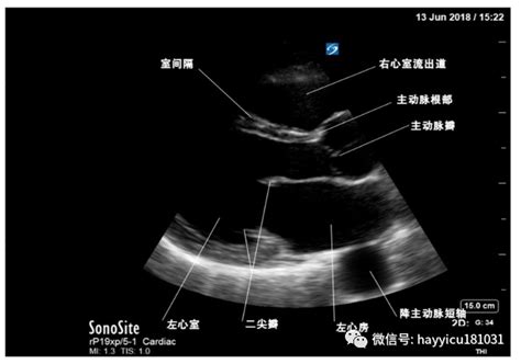 超声心动图切面与室间隔缺损分型示意图a 胸骨旁左心长轴切面 b 心底 动态图库网