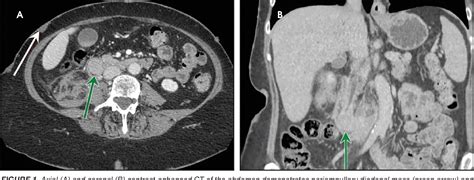 Pdf Gist Of The Duodenum And Proximal Jejunum With An Ampullary