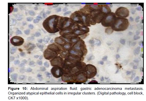 Cellular And Molecular Biology The Contribution Of Cell Block Method To Histopathological And