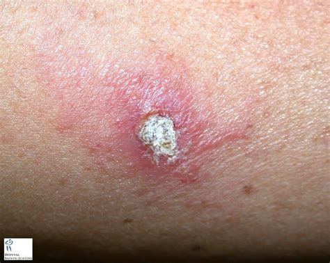 Leishmaniasis Disease