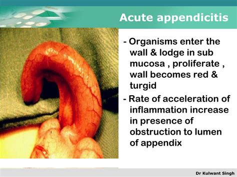 Ppt Appendicitis Powerpoint Presentation Free Download Id 1703196