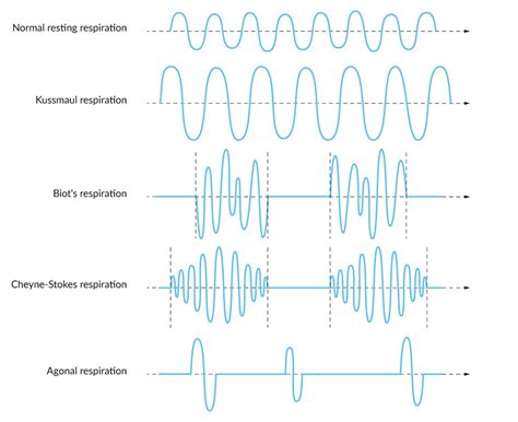 Kussmaul Breathing Pattern
