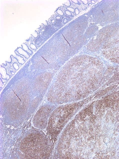 Follicular Lymphoma Grade 1 3 In A Hepatic Flexure Polyp 6