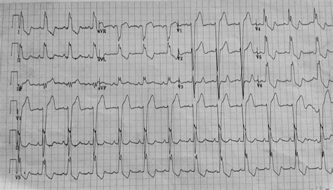 Right Bundle Branch Block STEMI
