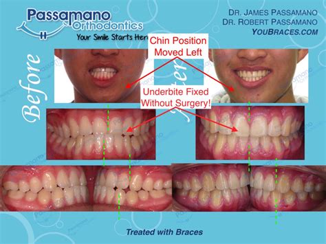 Underbite Class 3 Fixed With Braces Only No Surgery Amazing Finish Passamano Orthodontics