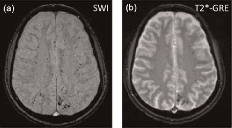 A Susceptibility Weighted Imaging Swi Is Currently The Most