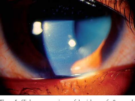 Figure 1 From Posterior Polymorphous Dystrophy And Keratoconus More Figure 1 From Posterior Polymorphous Dystrophy And Keratoconus More