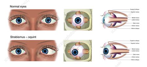 Normal Eye And Strabismus Illustration Stock Image C0573945 Science Photo Library