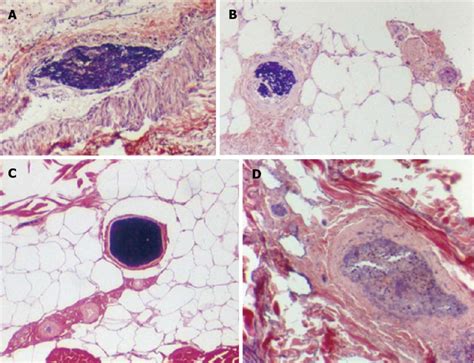 The Thrombi Sludge And Necrotic Debris In Burnt Skin Subcutaneous