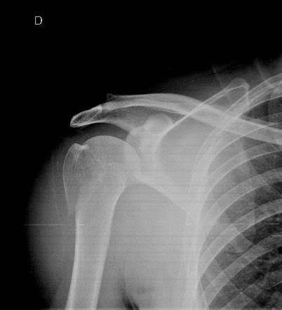 Greater Tubercle Of Humerus Fracture