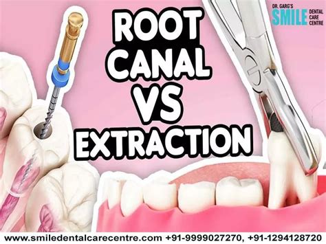 Ppt What Are The Side Effect And Dangers Of Root Canal Treatment