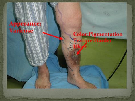 Peripheral Vascular Disease
