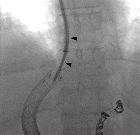 Angiographic Patterns Of Transjugular Intrahepatic Portosystemic Shunt Dysfunction And