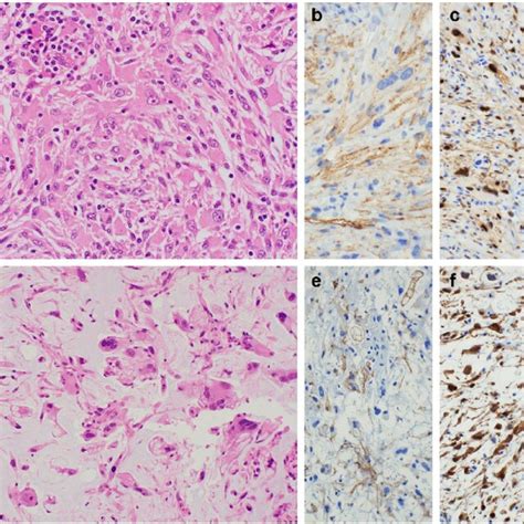 Pdf Usefulness Of Syncam3 And Cyclin D1 Immunohistochemistry In