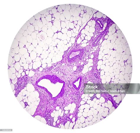 Fotomikrograf Histologi Jaringan Granulomatosa Menunjukkan Granuloma Benda Asing Foto Stok