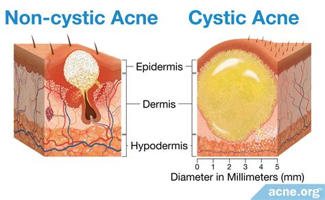 Regular Acne Vs Cystic Acne Whats The Difference