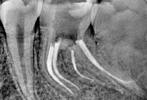 Management Of A Type Iii Radix Entomolaris In A First Lower Molar Style Italiano Endodontics