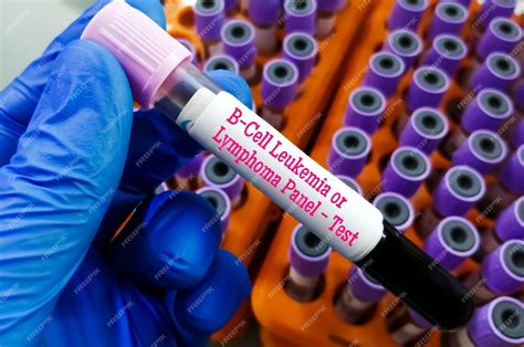 Premium Photo B Cell Leukemia Or Lymphoma Panel Test To Diagnose