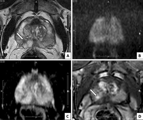 Pirads 4 Lesion After Dce Assessment 80 Year Old Man With Elevated Psa