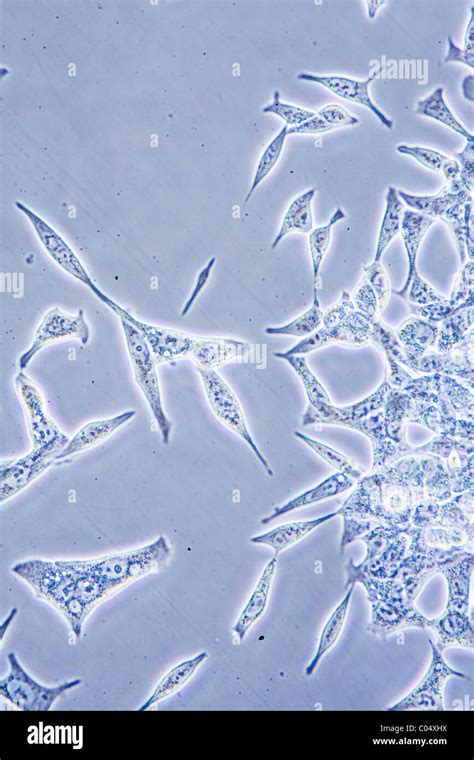 Microscope View Of Prostate Cancer Cells In Tissue Culture Showing