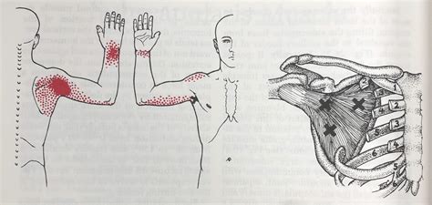 Subscapularis Trigger Point How To Find And Self Release