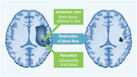 Ischemic Stroke Pathophysiology