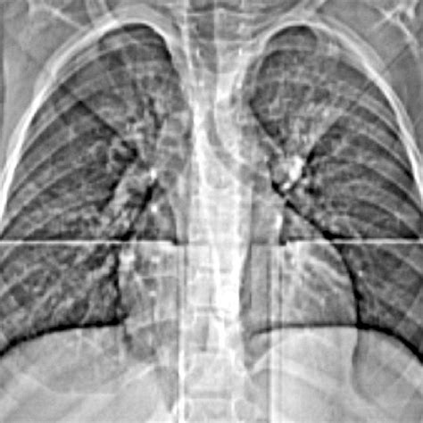 Severe Bulbo Duodenitis With Mild Diffuse Bleeding Download Scientific Diagram