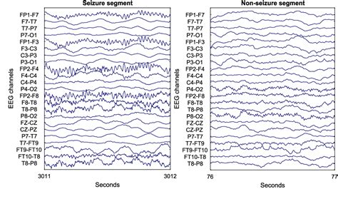 Figure 2 From Real Time Automated Epileptic Seizure Detection By Analyzing Time Varying High