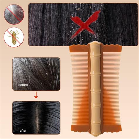 Asieit Lice Comb Flea Lice Removal Comb Double Sided Head Lice Comb