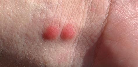 Scabies Bites On Humans