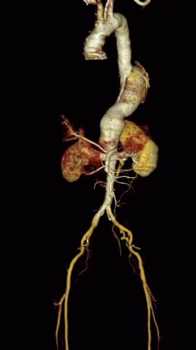 Video Dr Rinoy R Anand Dnb Fnvir Ebir On Linkedin Aortic