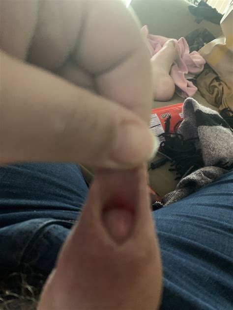 My Foreskin Pics Xhamster