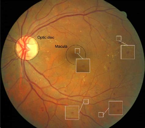 Figure 1 From Retinal Microaneurysm Detection Through Local Rotating