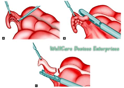 Wellcare Devices Enterprises On Linkedin Appendix Appendectomy Laparoscopicappendectomy
