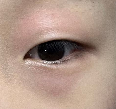 눈 주위에 빨간 게 올라왔는데 뭘까요 지식in