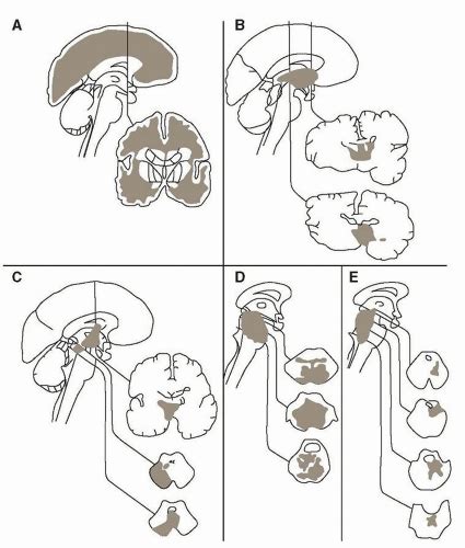 Stupor And Coma Neupsy Key