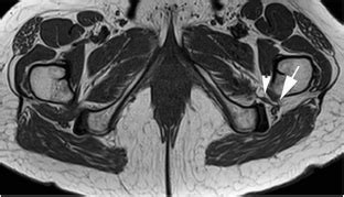 Deep Gluteal Syndrome Anatomy Imaging And Management Of Sciatic
